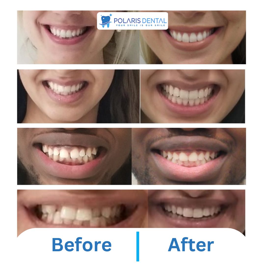 How Braces Close Gaps Between Teeth - Polaris Dental
