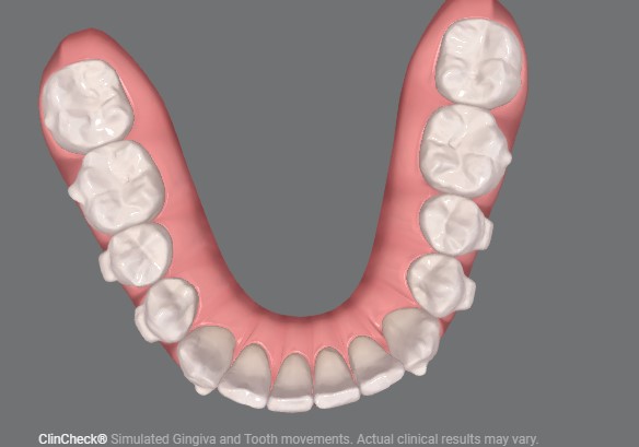 Single-Arch Invisalign Treatment Cost $2600 (Upper or Lower Teeth Only ...