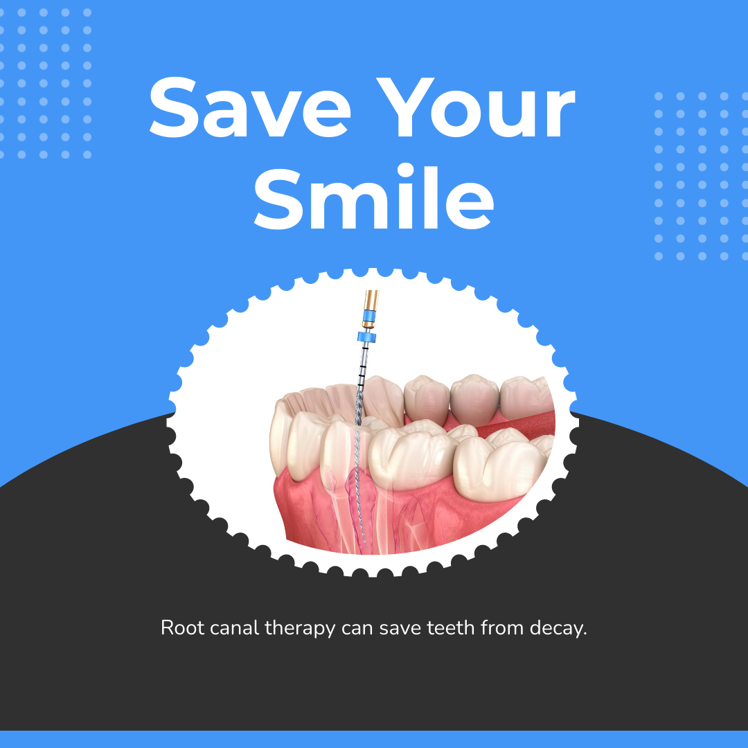 Root Canal Tooth: How Long Does It Last? Will It Fall Out? - Polaris Dental